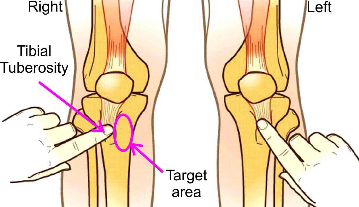 Tibial Tubercle Palpation